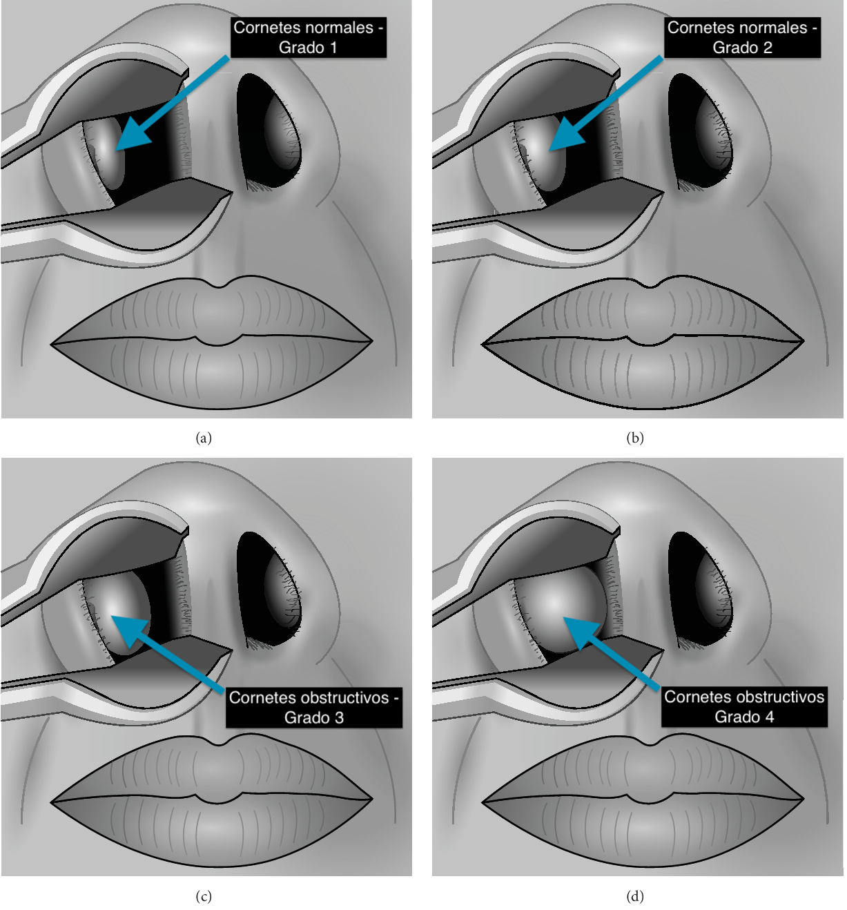 Nariz: Tabique Y Cornetes, Rinitis, Sinusitis